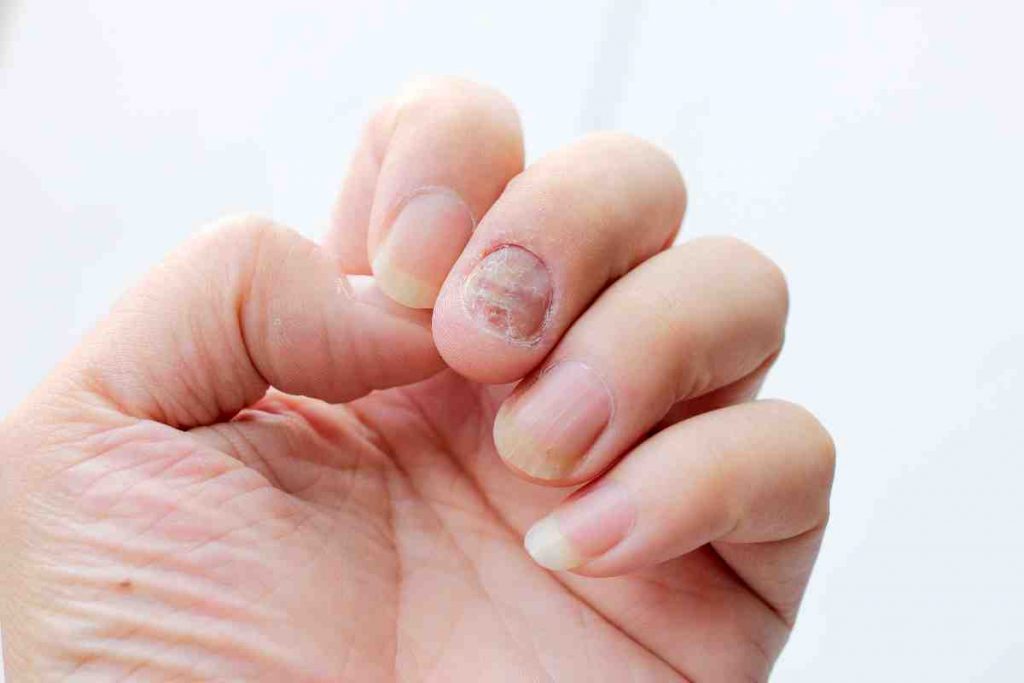 Funghi su mani e piedi, il rimedio fai da te - www.parolibero.it